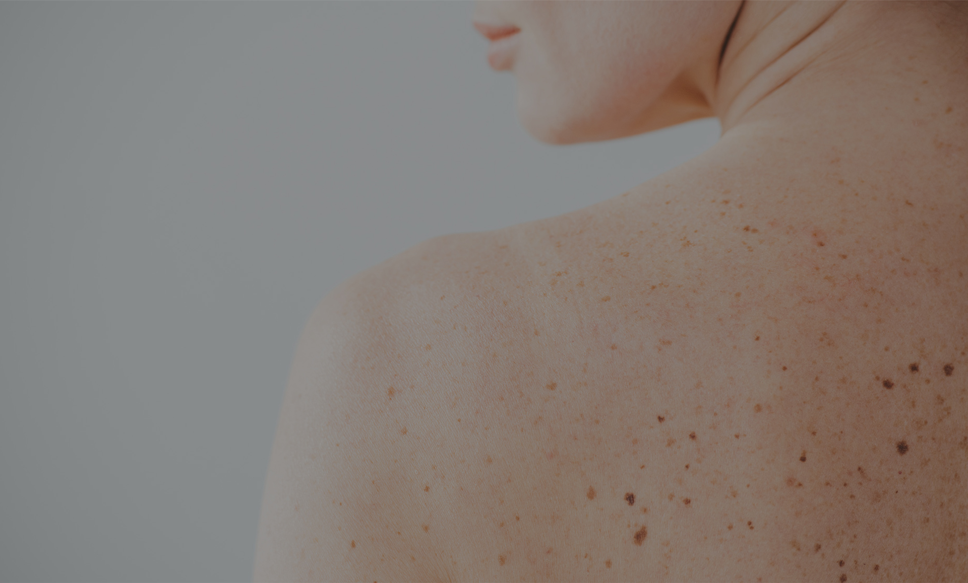 Hyperpigmentation Treatment London - b.e.a Skin Clinic